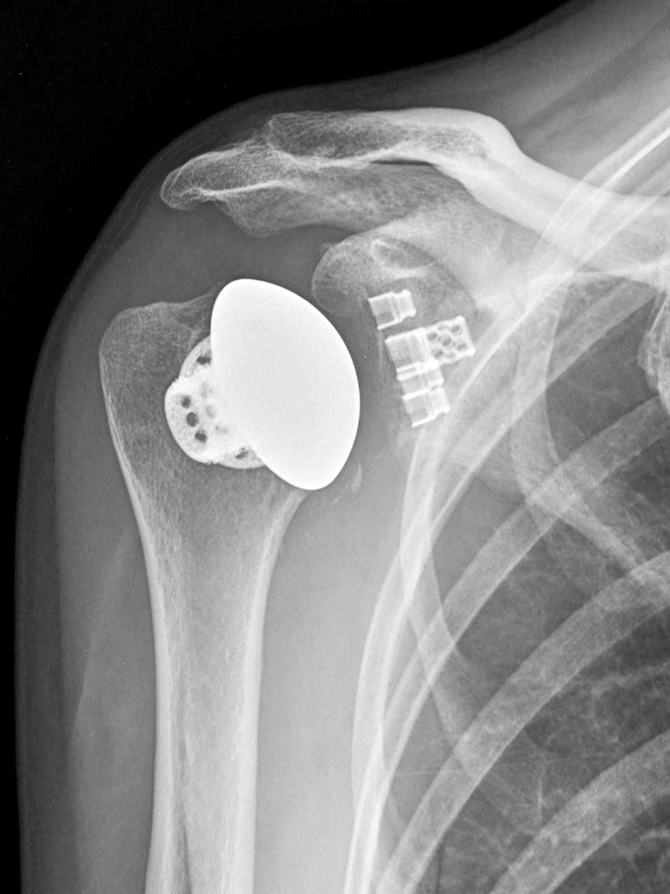 Exactech changes the additive fabrication process of a shoulder ...
