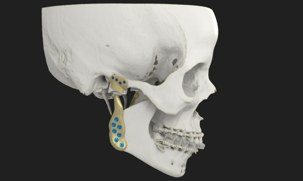 3D printing company Materialise could enhance jaw treatments with a 3 ...