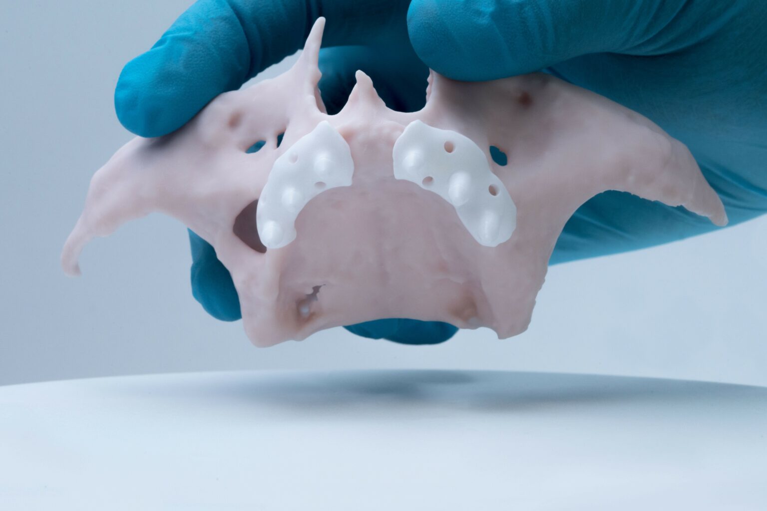 A jaw implant 3D printed with Lithoz ceramic 3D printing is ...