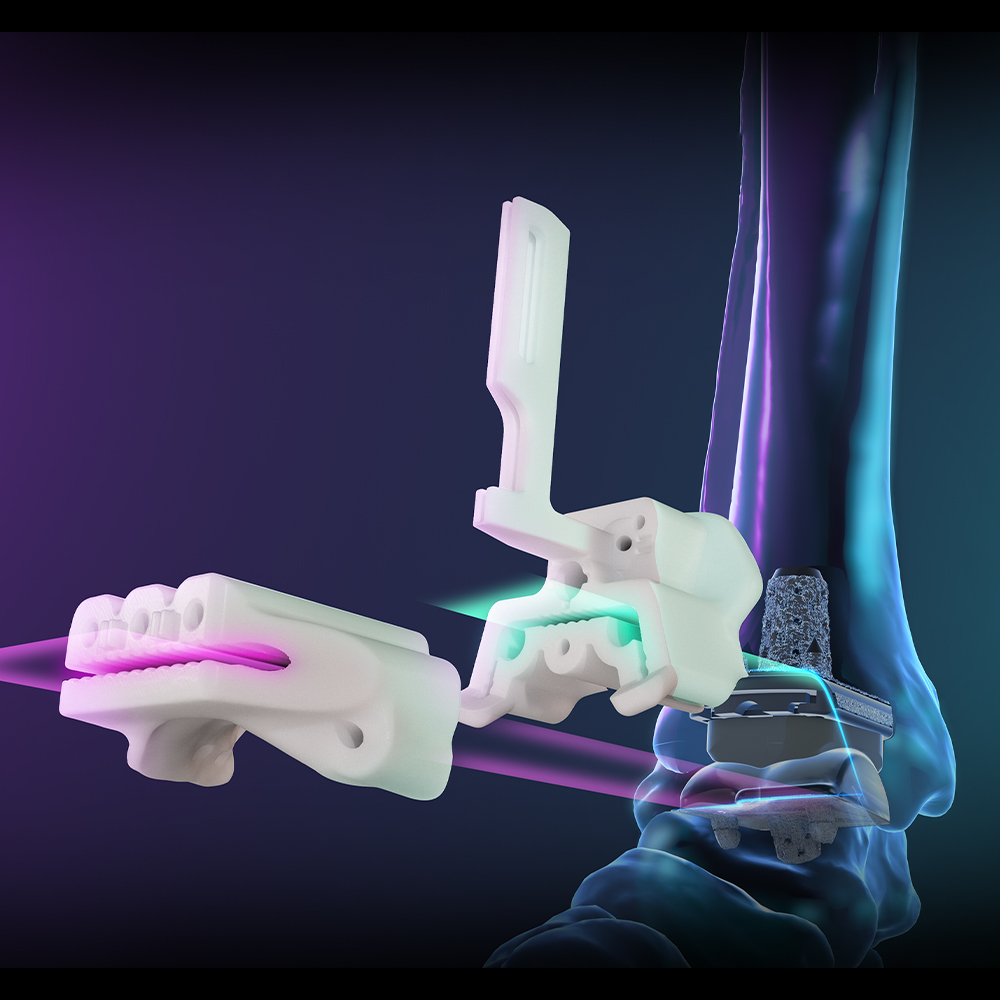 Exactech announces the completion of their first ankle surgery with 3D ...