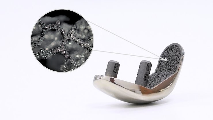 Croom Medical introduces a 3D-printed porous ingrowth technology for ...